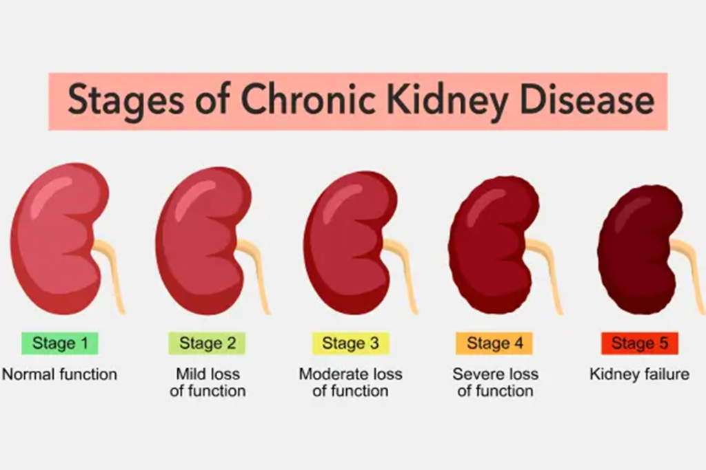 CKD (Chronic Kidney Disease) – KDM hospital