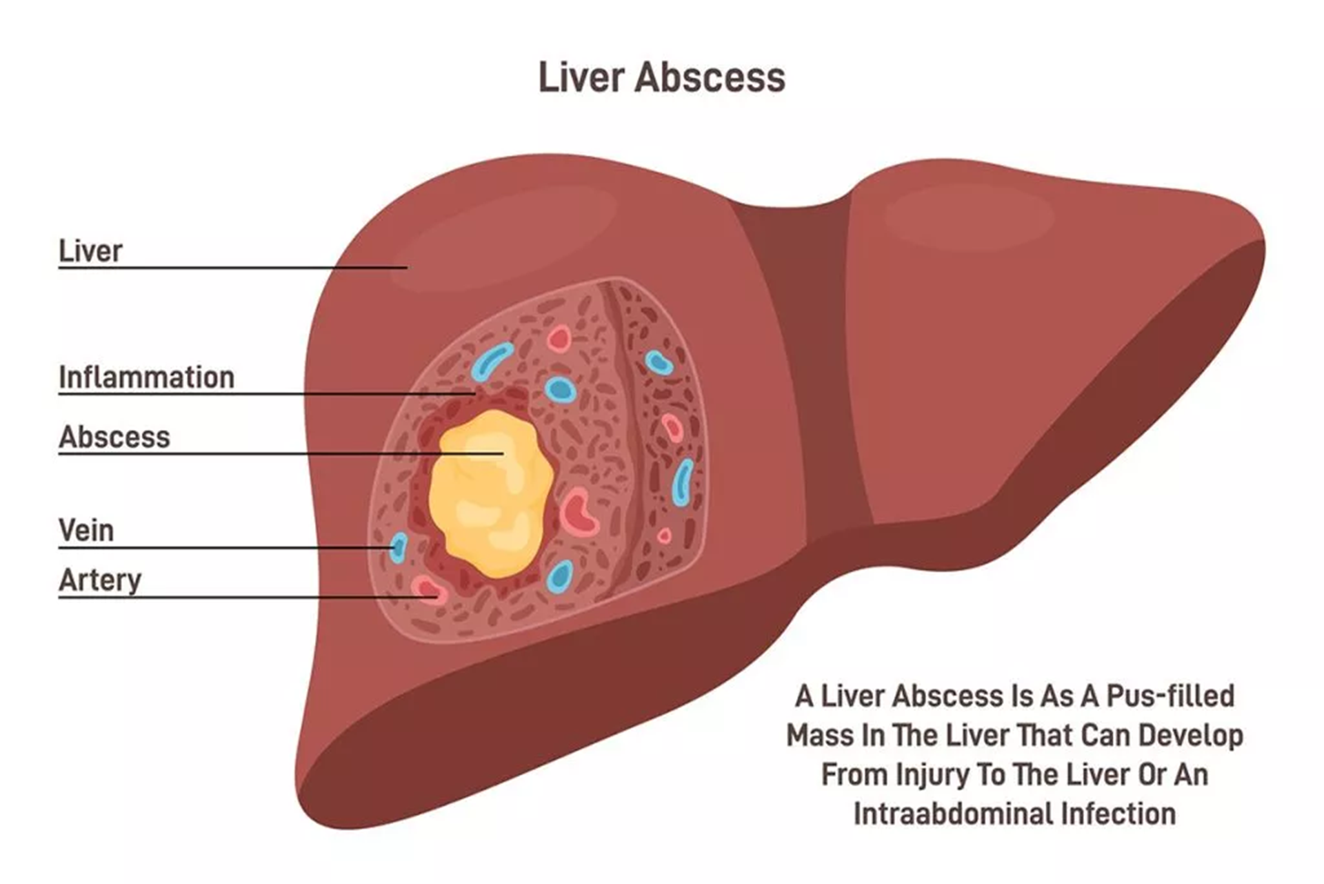 Liver abscess – KDM hospital
