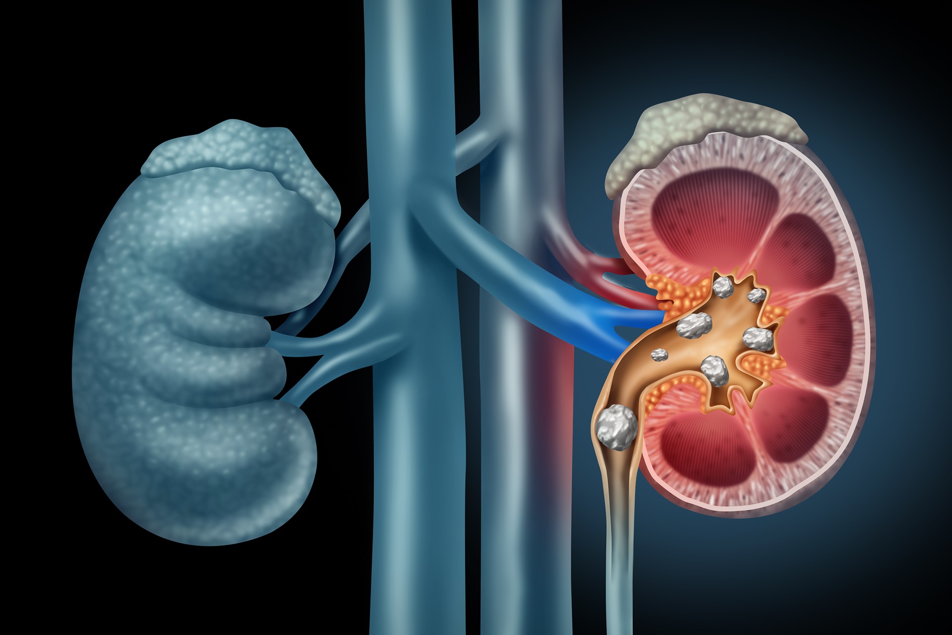 Renal stone – KDM hospital