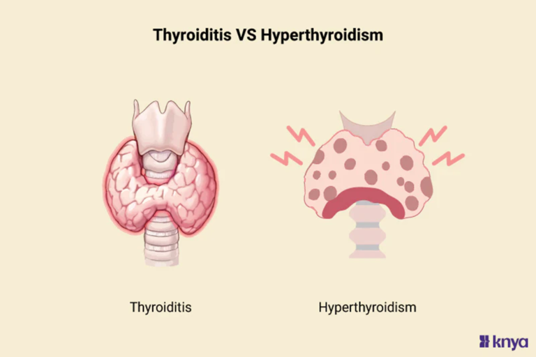 Thyroiditis – KDM hospital